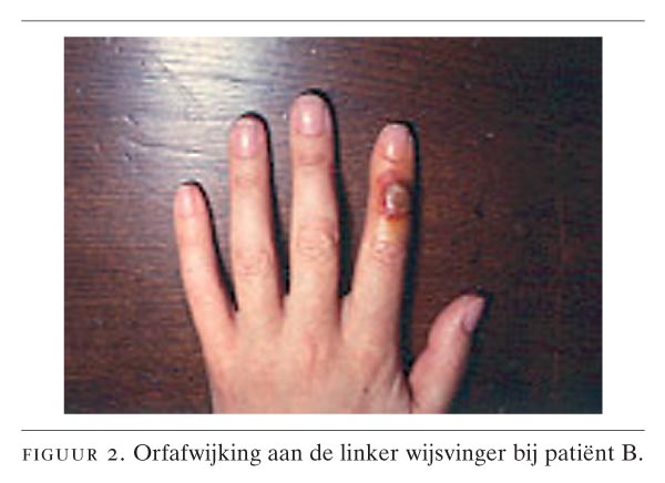 Drie patiënten met orf (ecthyma contagiosum) | Nederlands Tijdschrift ...