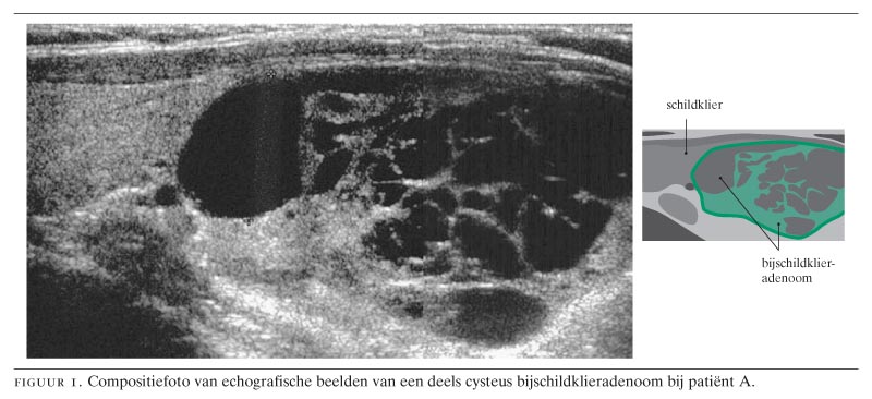 Een patiënte met een palpabele zwelling in de hals door een cysteus ...