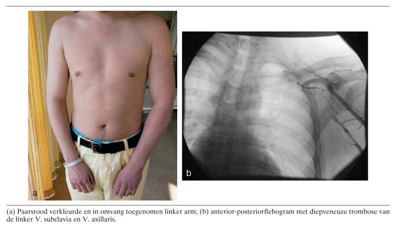 Diagnose in beeld (188). Een man met een gezwollen en rode arm | NTVG