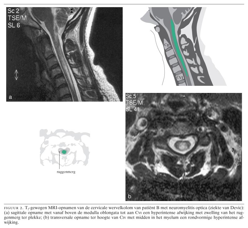 Neuromyelitis optica (ziekte van Devic): een zware variant van multiple ...