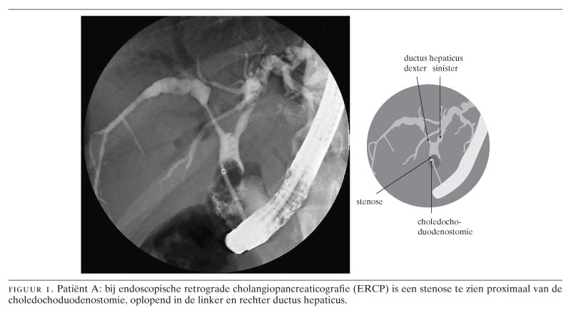 Obstructie-icterus na galwegchirurgie: een benigne strictuur of niet ...