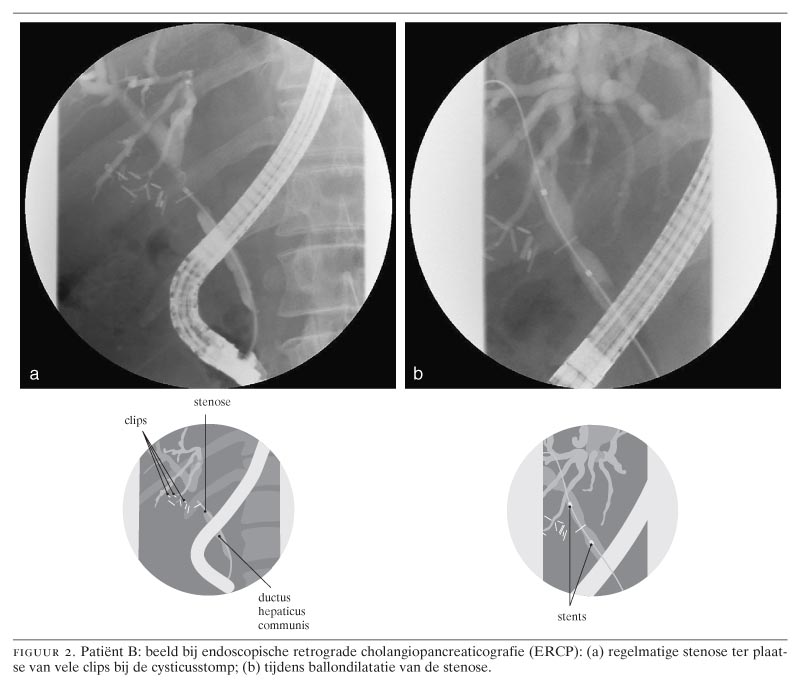 Obstructie-icterus na galwegchirurgie: een benigne strictuur of niet ...