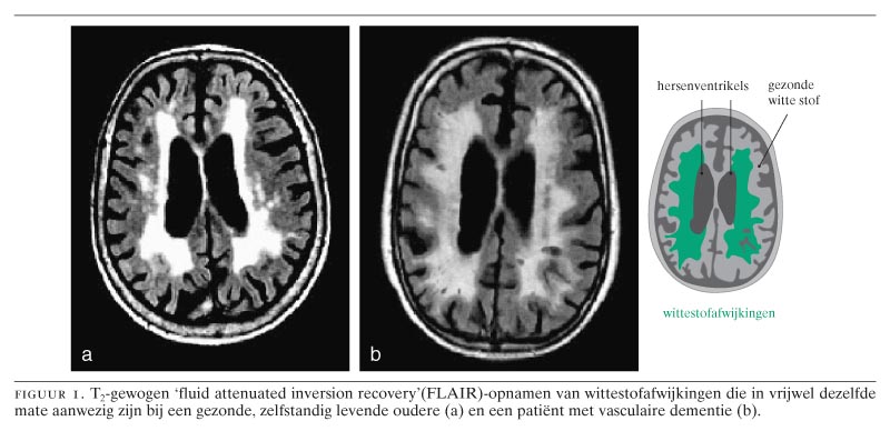 Vasculaire dementie | Nederlands Tijdschrift voor Geneeskunde