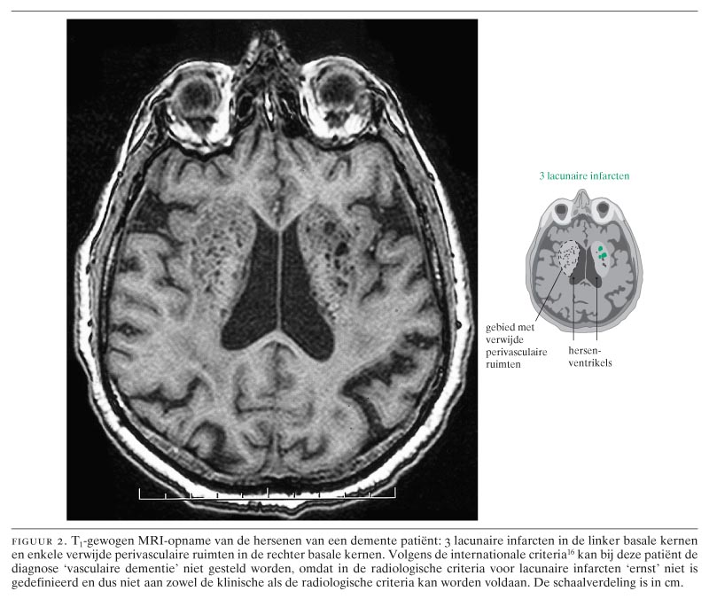 Vasculaire dementie | NTVG