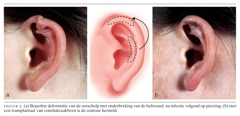 3 patiënten met complicaties als gevolg van piercing van het ...