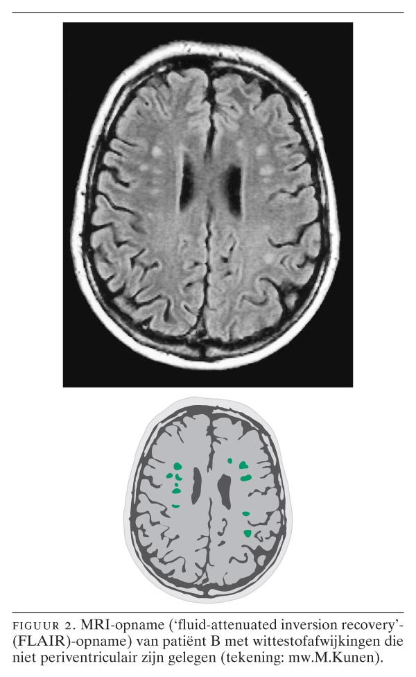 Nieuwe diagnostische criteria voor multiple sclerose in de praktijk ...