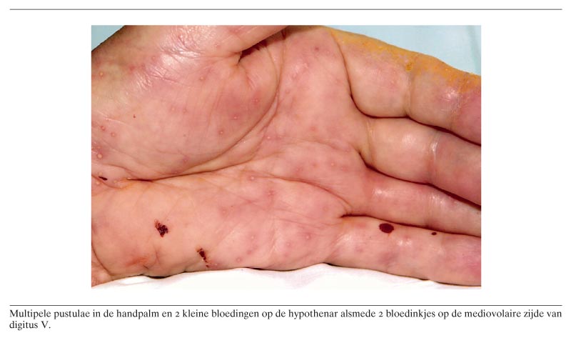 Diagnose in beeld (199). Een vrouw met palmaire pustulae | NTVG