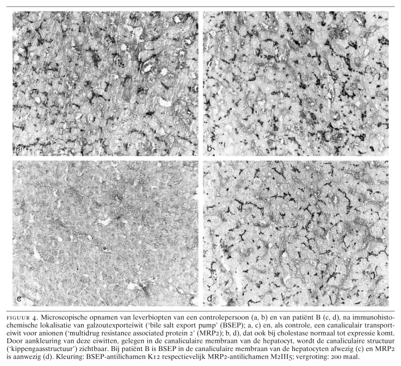 Twee zusjes met progressieve familiaire intrahepatische cholestase | NTvG