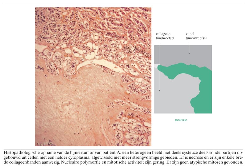 Het bijnierschorscarcinoom, een tumor met een grote klinische verscheidenheid | Nederlands ...