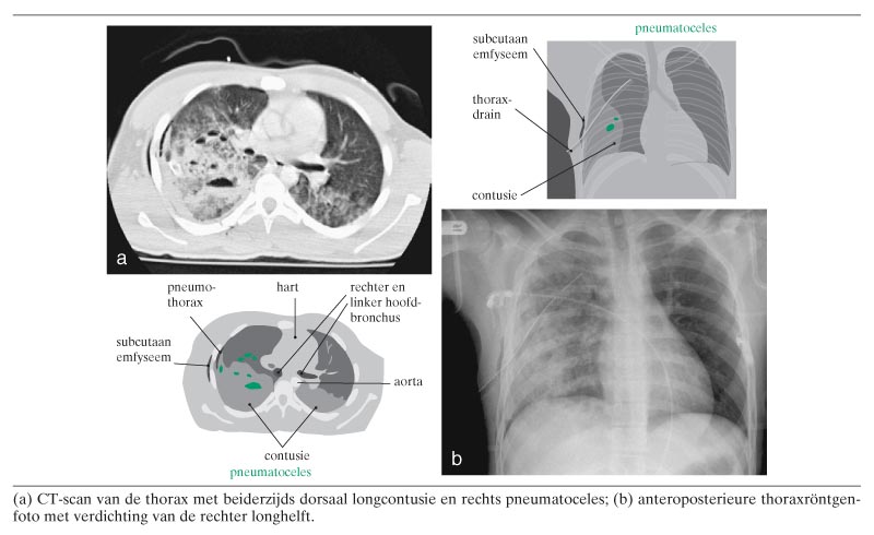 Diagnose in beeld (214). Een jongeman met een thoraxtrauma | NTVG