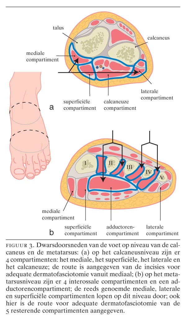 Het acute compartimentsyndroom van de voet | NTVG