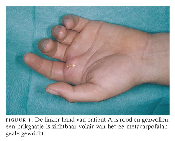 Verwonding van de hand door een hogedrukspuit: vaak grote onderhuidse ...