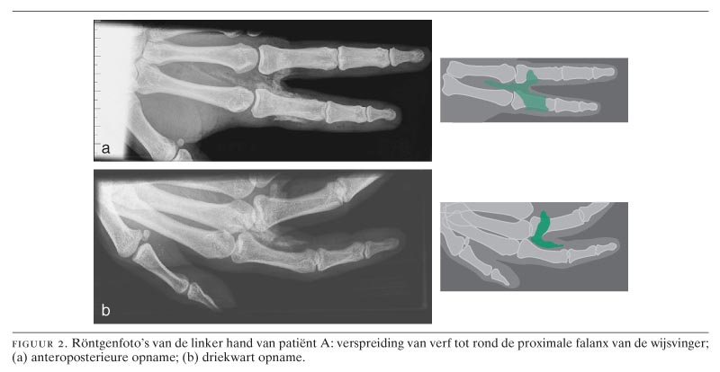 Verwonding van de hand door een hogedrukspuit: vaak grote onderhuidse ...