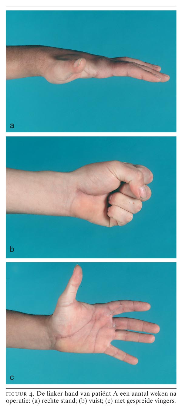 Verwonding van de hand door een hogedrukspuit: vaak grote onderhuidse ...