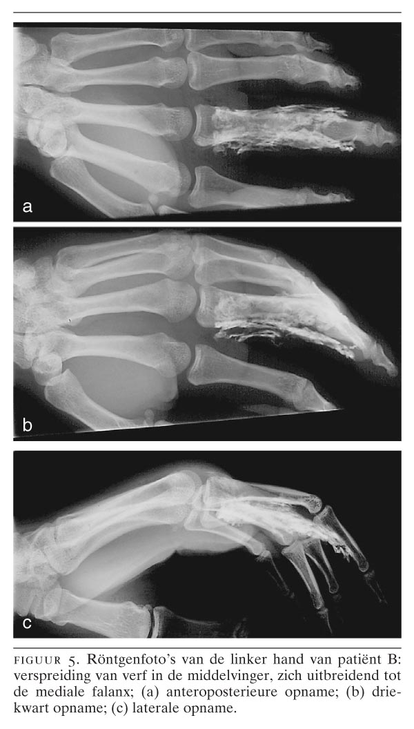 Verwonding van de hand door een hogedrukspuit: vaak grote onderhuidse ...