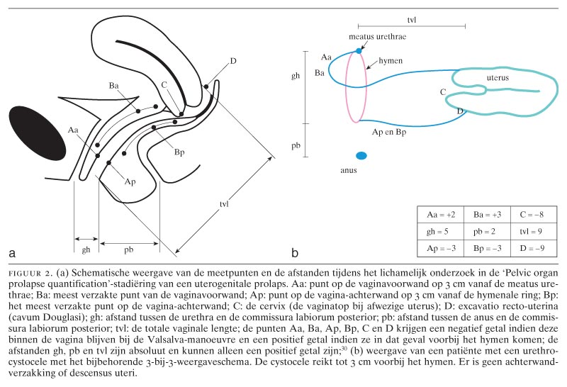Diagnostiek van uterovaginale prolaps | NTVG