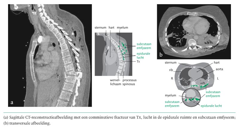 Diagnose in beeld (221). Een vrouwelijke multitraumapatiënt ...