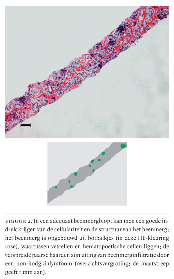 Indicaties voor beenmergbiopsie bij volwassenen | Nederlands ...