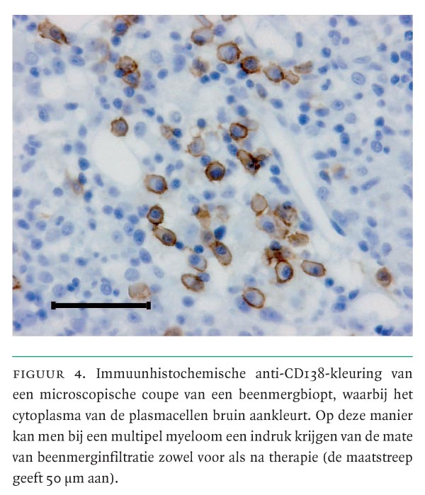 Indicaties voor beenmergbiopsie bij volwassenen | Nederlands ...