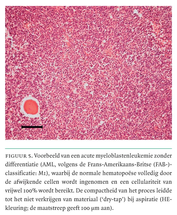 Indicaties voor beenmergbiopsie bij volwassenen | NTvG