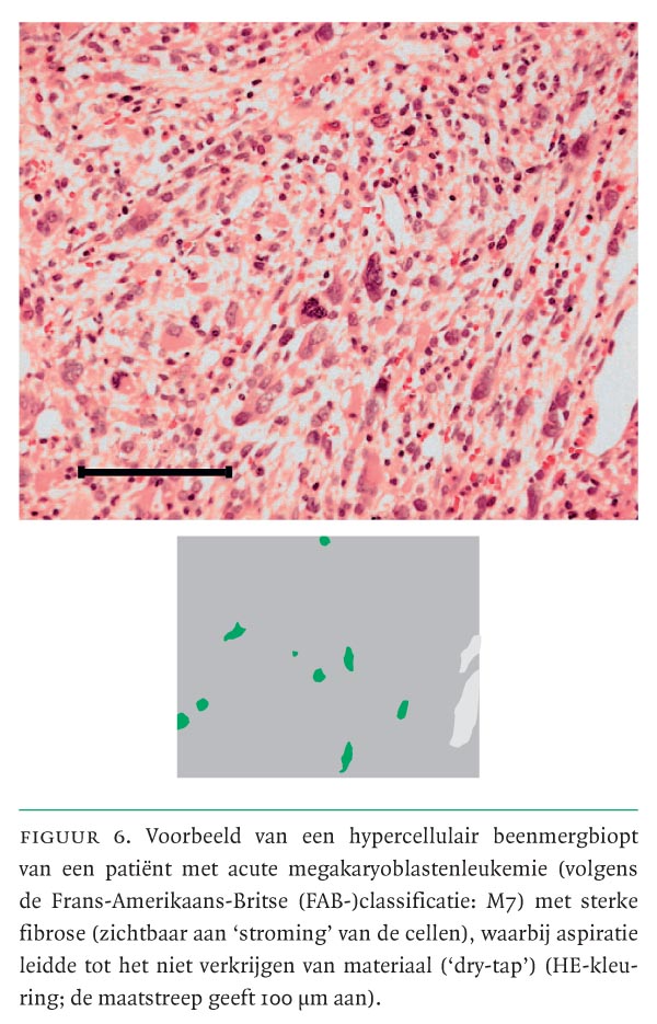 Indicaties voor beenmergbiopsie bij volwassenen | Nederlands ...