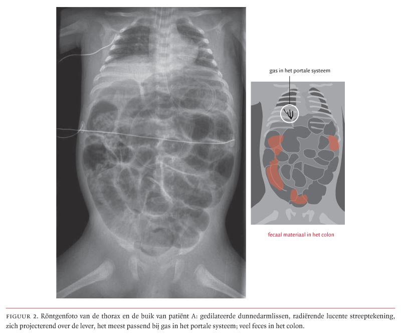 3 zuigelingen met obstipatie en hypotonie: infantiel botulisme ...
