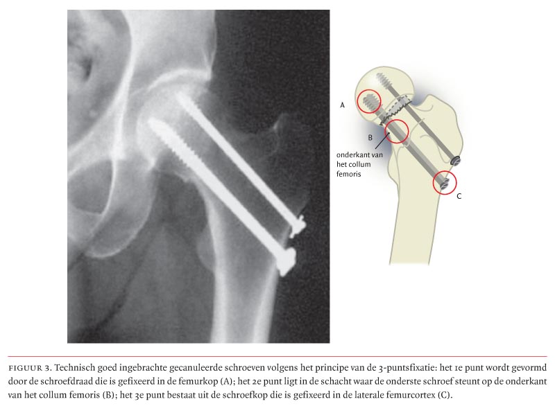 Grote variatie in indicaties voor interne fixatie of artroplastiek bij ...