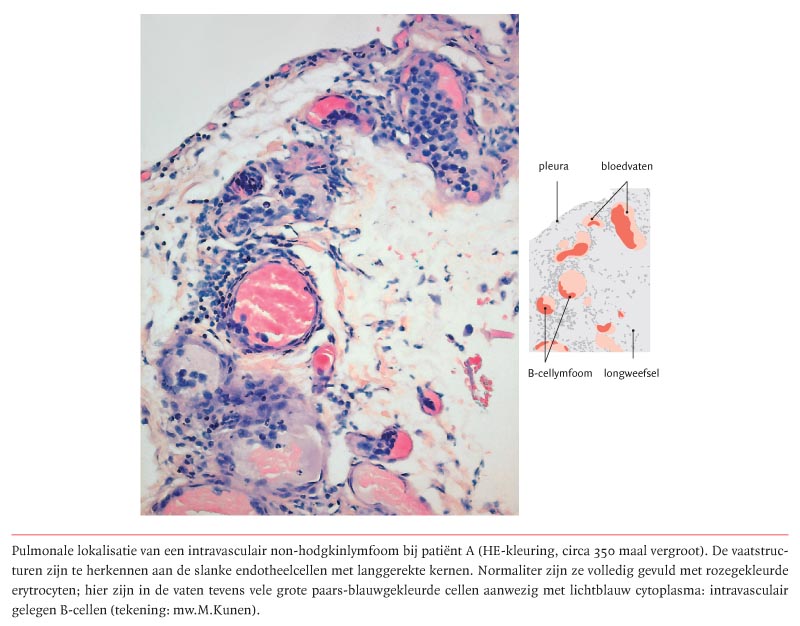 Het intravasculair lymfoom; een zeldzame, maar curabele oorzaak van ...