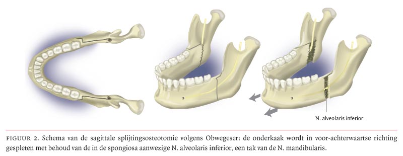 Obstructief slaapapneusyndroom; goede resultaten met osteotomie van ...