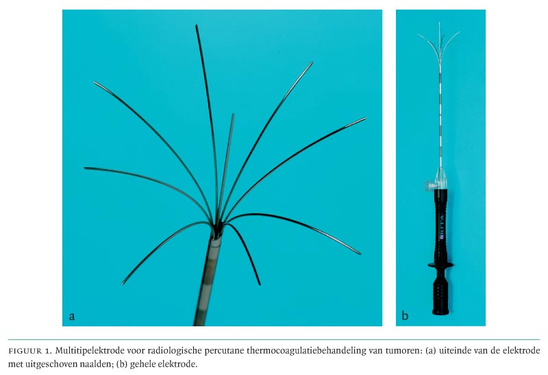 Radiologische percutane thermocoagulatiebehandeling van lever-, nier ...