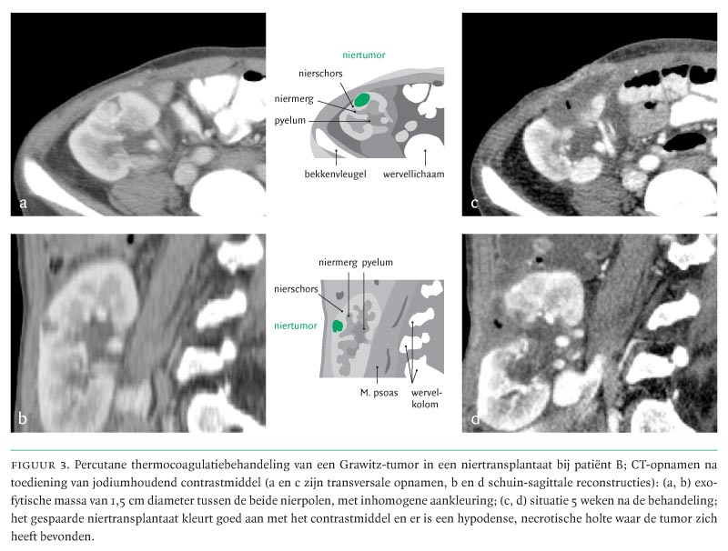 Radiologische percutane thermocoagulatiebehandeling van lever-, nier ...
