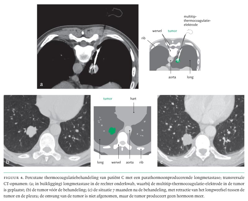 Radiologische percutane thermocoagulatiebehandeling van lever-, nier ...