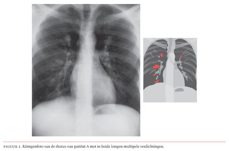 Hemoptoë als complicatie van de ziekte van Behçet | Nederlands ...