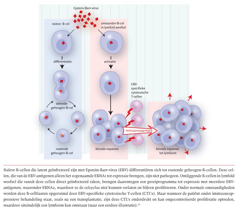 Epstein-Barr-virus-gerelateerde lymfomen bij patiënten met ...