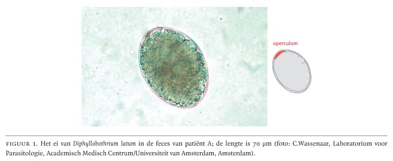 Infestatie met de lintworm Diphyllobothrium latum na het eten van rauwe ...