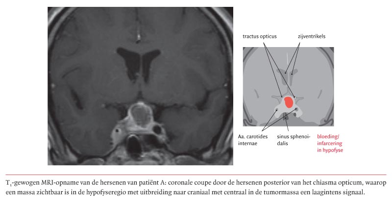 Apoplexie van de hypofyse: een endocrinologisch spoedgeval | NTVG