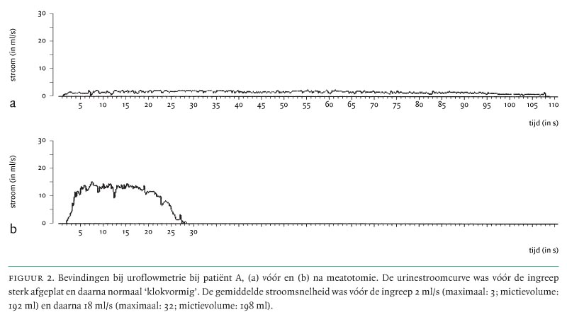 Urethrale-meatusstenose bij jongens gemakkelijk gemist | Nederlands ...