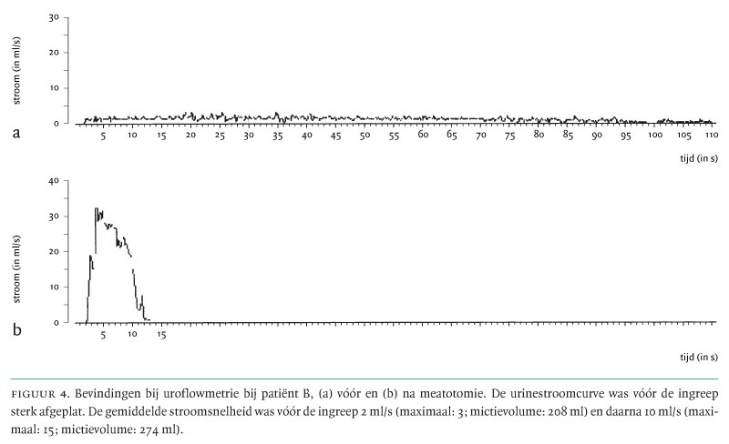 Urethrale-meatusstenose bij jongens gemakkelijk gemist | NTVG