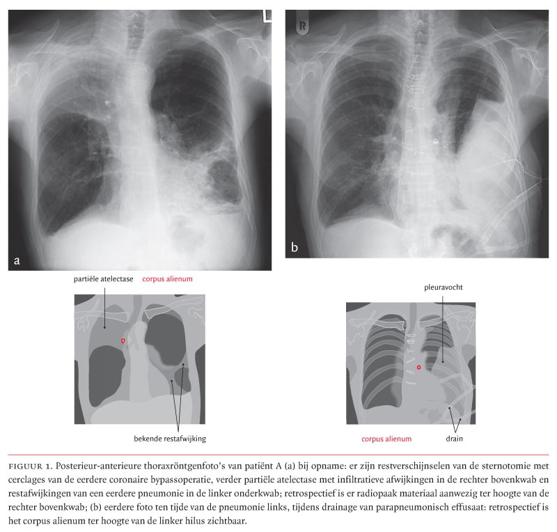 Verspringende longinfiltraten door een corpus alienum | NTVG