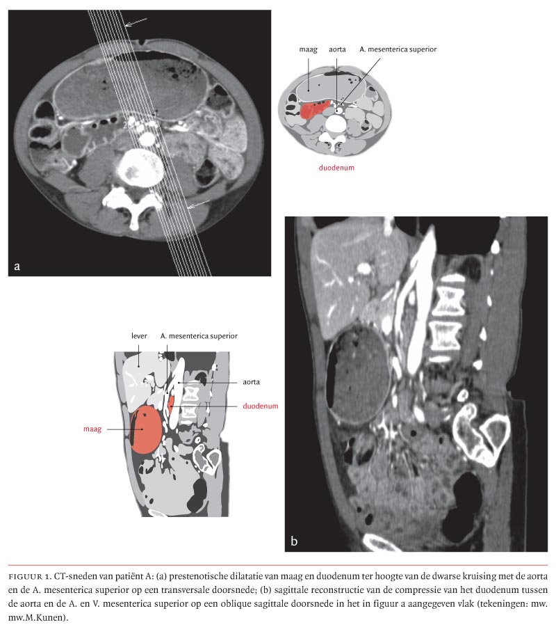 Intermitterend braken van een patiënte met het A.-mesenterica ...