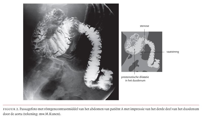 Intermitterend braken van een patiënte met het A.-mesenterica ...