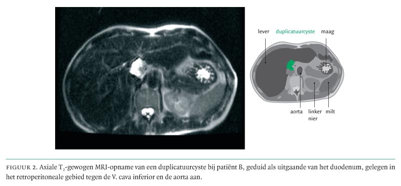 Incidentele cysteuze structuren in de bovenbuik: verwijderen of niet ...
