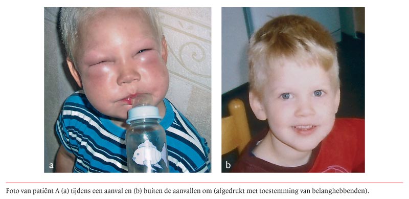 Aanvallen van angio-oedeem bij kinderen door C1 ...