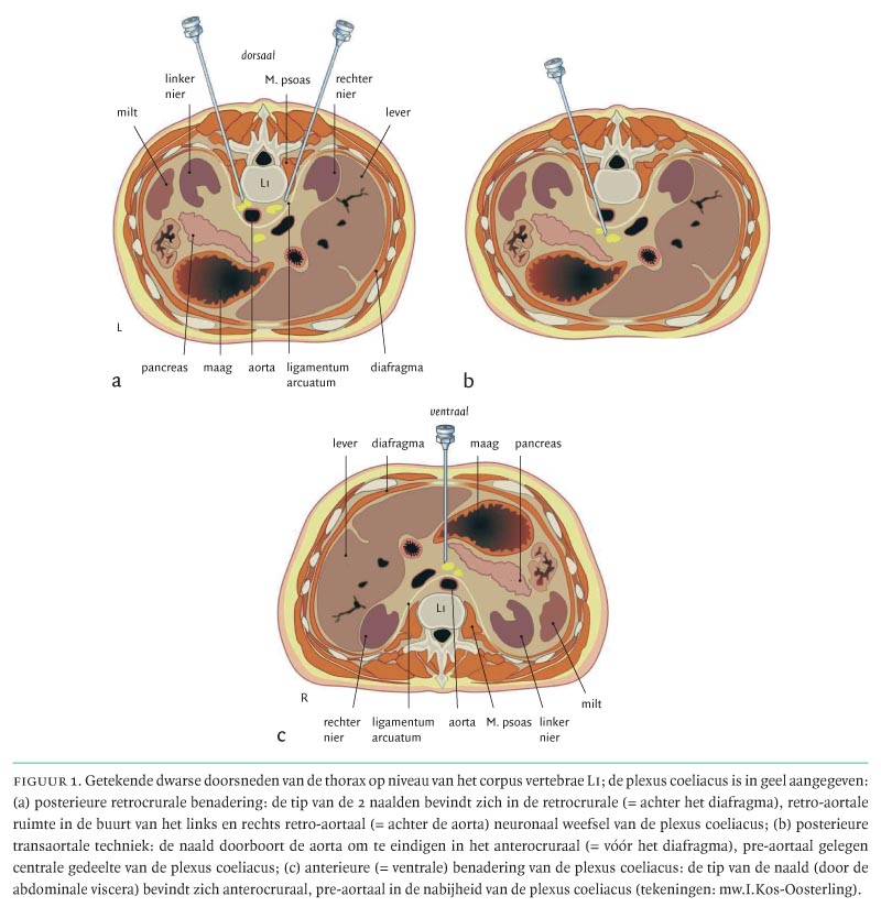 Blokkade van de plexus coeliacus bij patiënten met pijn door een ...