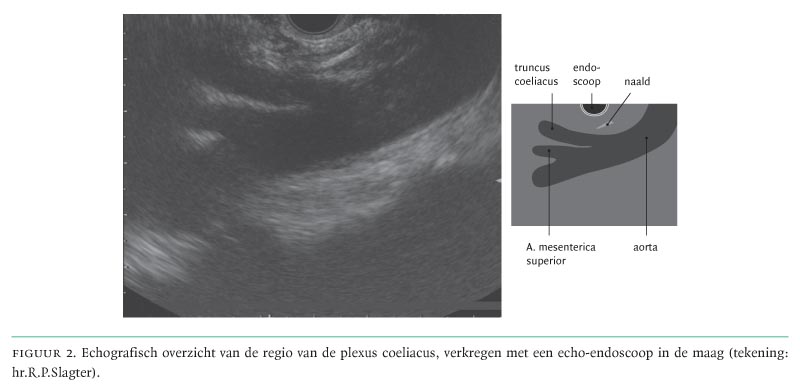 Blokkade van de plexus coeliacus bij patiënten met pijn door een ...