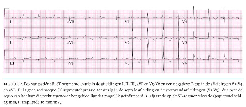 Longembolie Ecg / Pulmonary Pressures and ECG Patterns | EMS 12 Lead ...