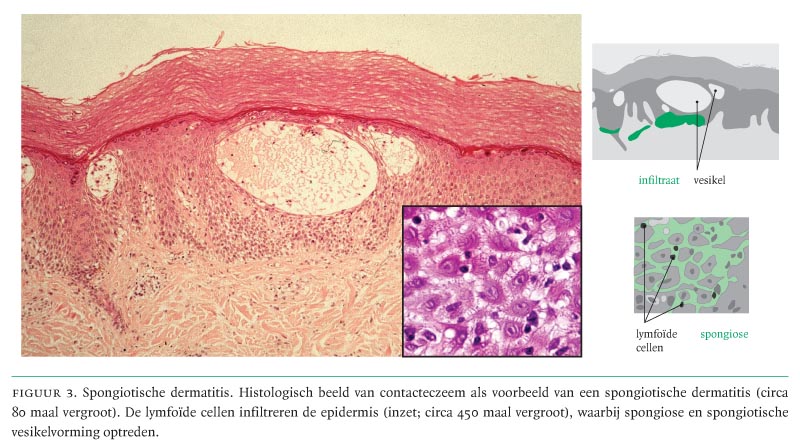 Het immuunsysteem van de huid en stereotiepe reactiepatronen bij ...