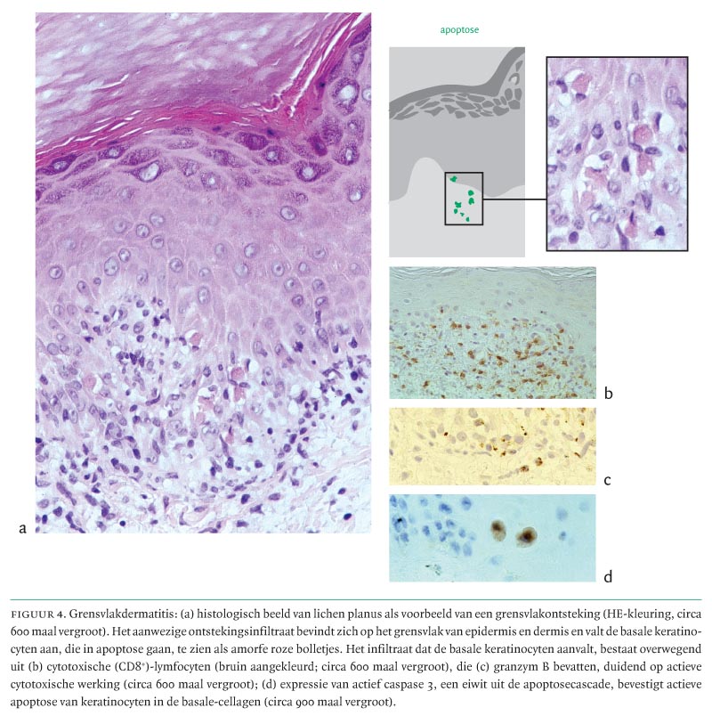 Het immuunsysteem van de huid en stereotiepe reactiepatronen bij ...