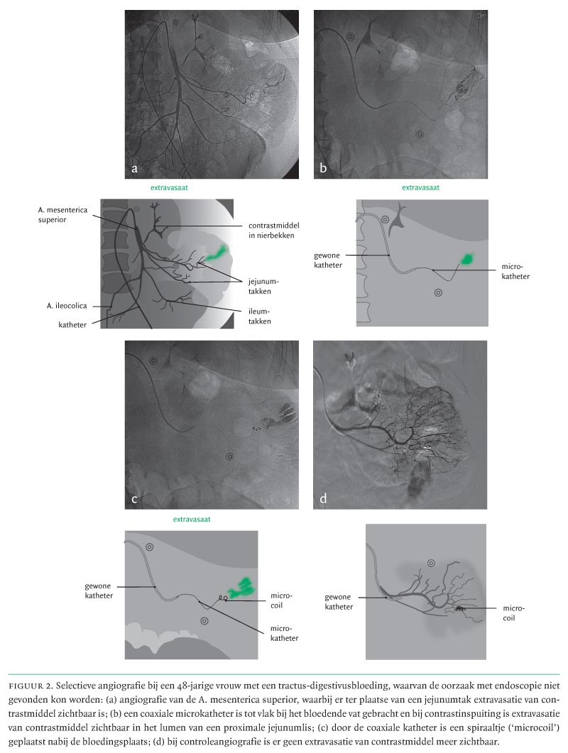 Toenemende rol van angiografische embolisatie bij de behandeling van ...