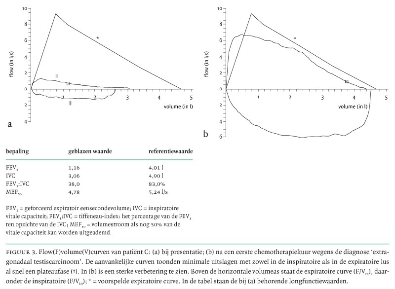 Dyspneu door vernauwing in de bovenste luchtwegen: eenvoudige ...